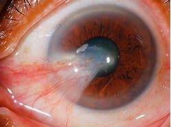Pterygium - Meaning, Causes, Symptoms, Types and Images