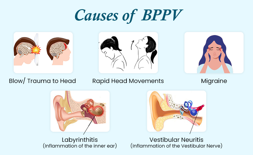 1 BPPV 1 BPPV