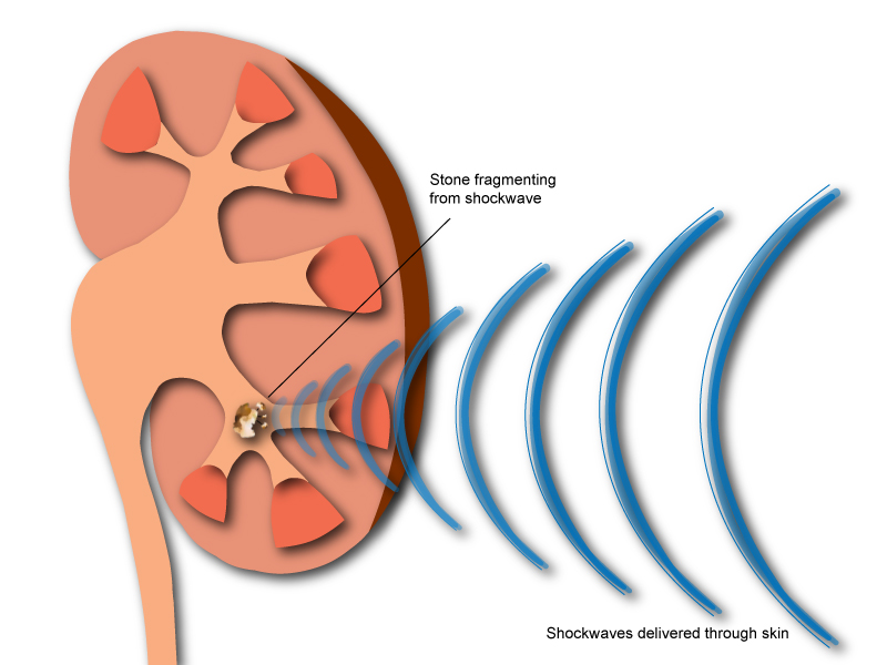 ESWL Treatment Procedure Benefits And Recovery