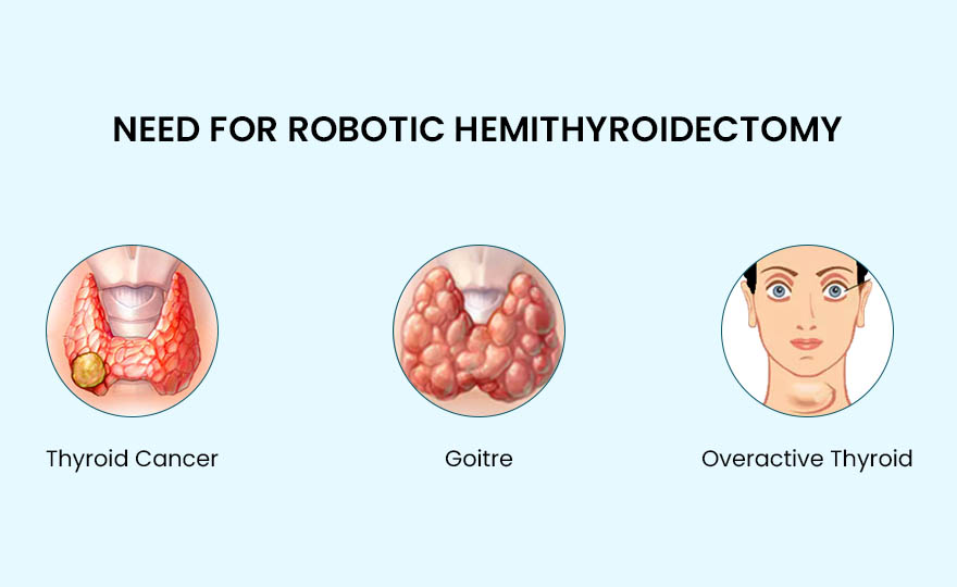 Robotic Hemithyroidectomy Definition Surgery Procedure Recovery Robotic Hemithyroidectomy Definition Surgery Procedure Recovery