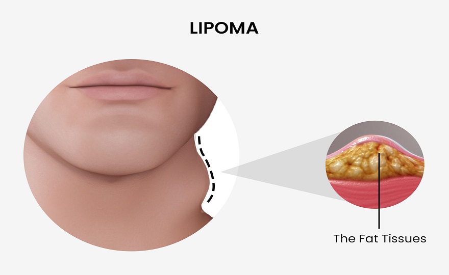 Lipoma - Meaning, Causes, Symptoms, Pictures & Types